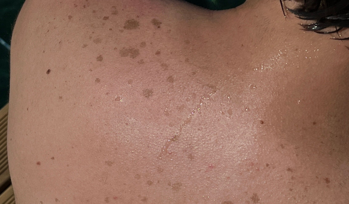 Sunburn vs. Sun Poisoning: How to Tell the Difference and What to Do ...